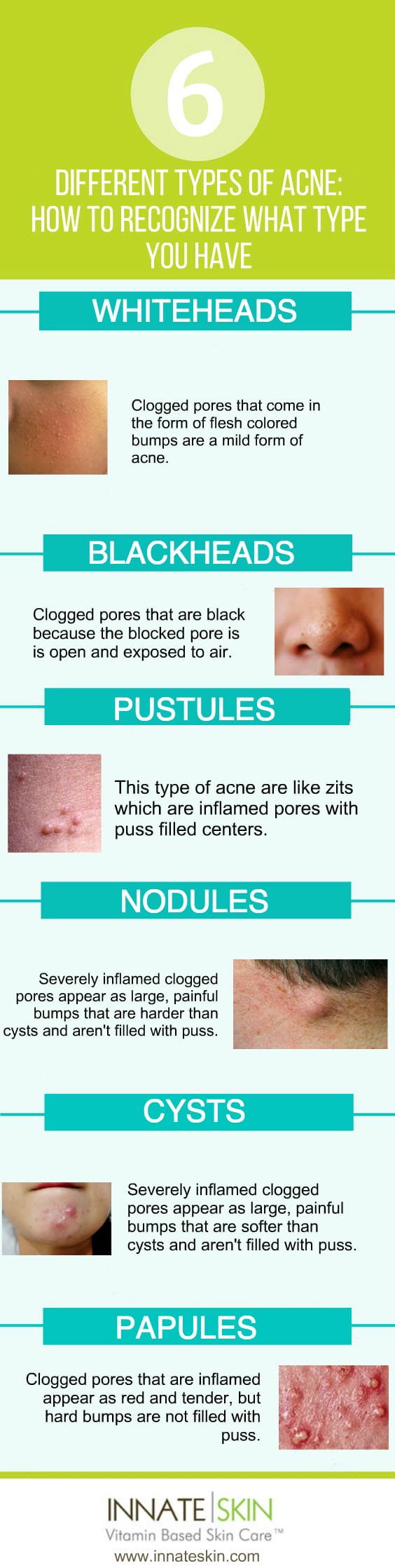 The Different Types of Acne: Which One Do You Have? - Innate Skin